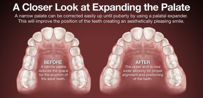 Sleep Apnea and Snoring - Grabill Family Dentistry