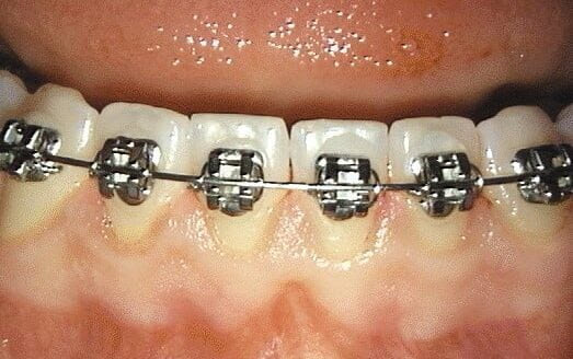 Air Flow® - Grabill Family Dentistry